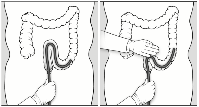 Significant Looping During Colonoscopy Crohns Disease Forum